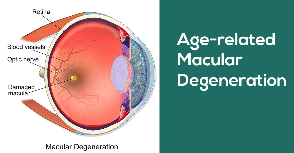 4 Most Common Eye Conditions Premier Medical Group In Mobile AL